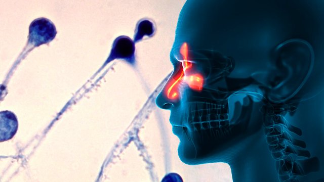 [Video] BBC: Qué es el mucormicosis, el "hongo negro" letal que ataca a ...